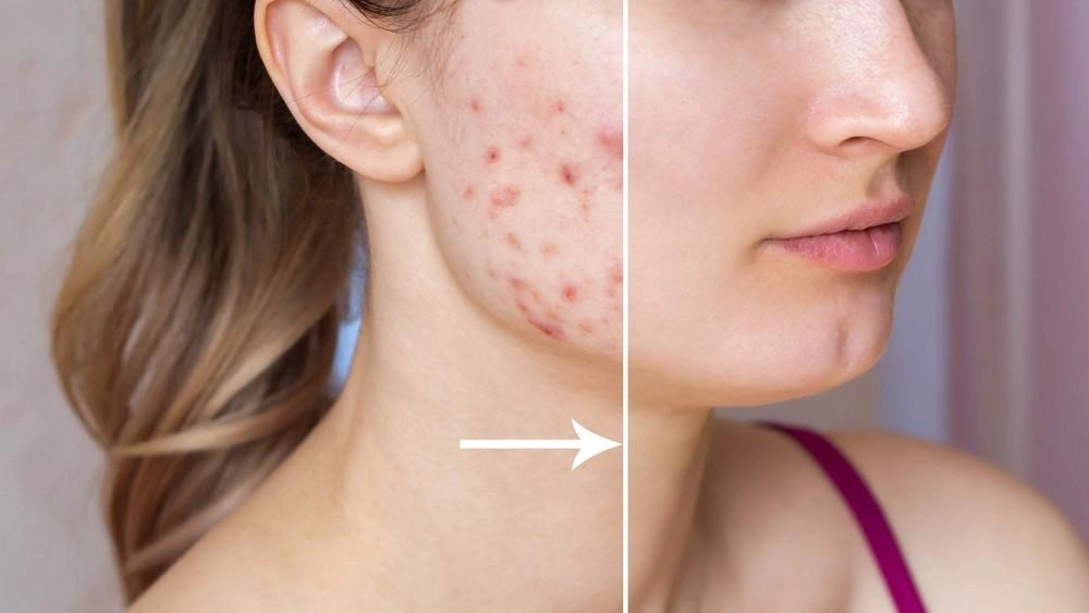 How to Treat Acne and Skin Blemishes Effectively