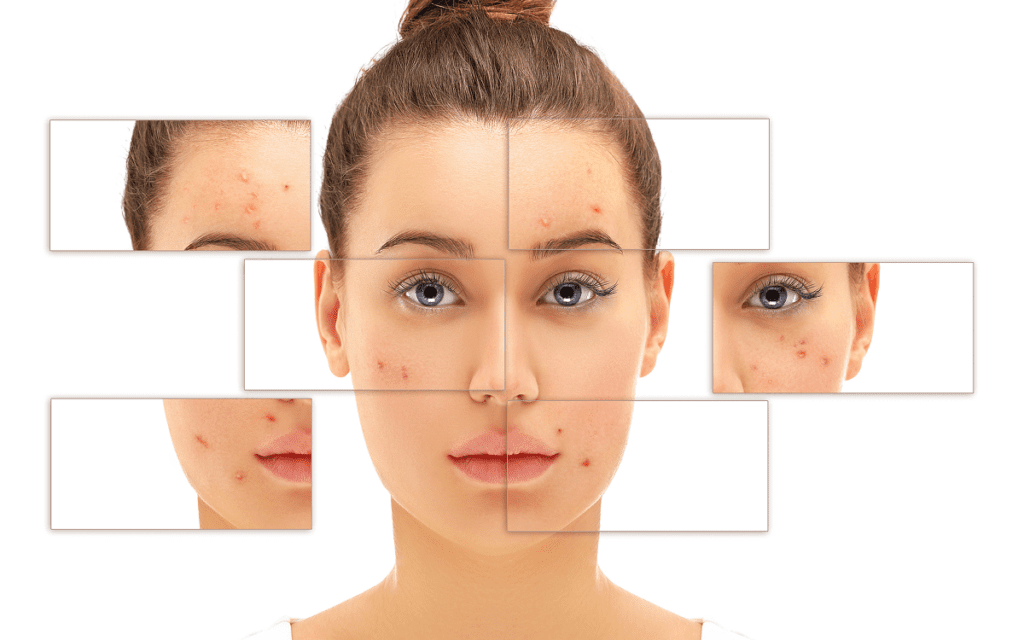 Hyperpigmentation: Causes and Treatable Options