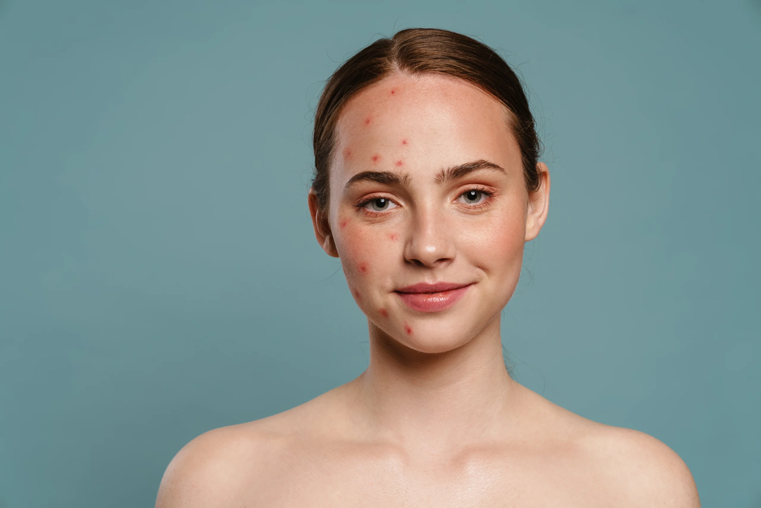 Acne in Adults: Causes & Modern Treatments